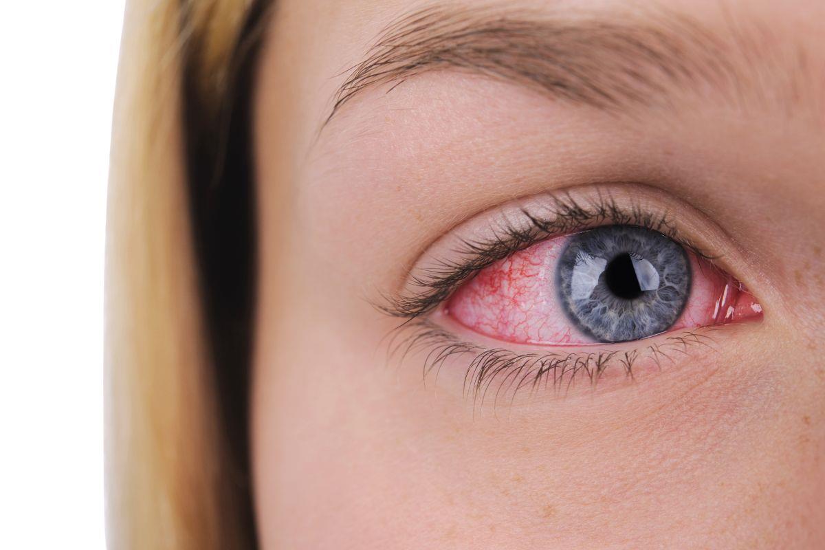 Crveno oko - MyPharmaSpace